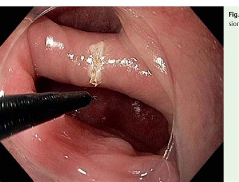 PDF Endoscopic Treatment Of Zenkers Diverticulum Using A Hook Knife