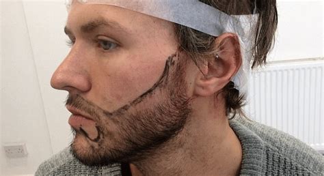 Beard Micropigmentation In Vancouver Get The Full Beard Look