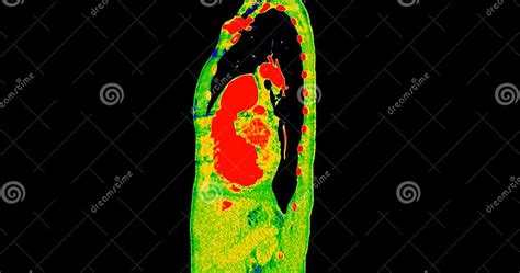 Ct Scan Of Chest Sagittal View In Color Mode For Diagnostic Pulmonary
