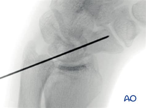Percutaneous Screw Fixation With Combined Approaches For Scaphoid Waist