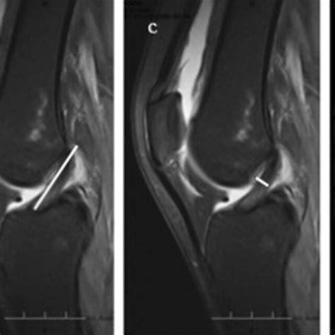 Measurements Of The Acl In The Sagittal A C And Axial D Planes The