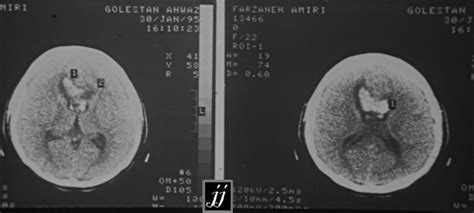 Hematoma Intraventricular Hematoma 4 Radioogle