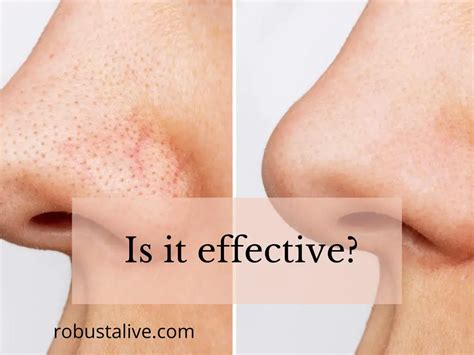 Blackhead Removal With Accutane Is It Effective