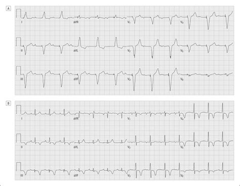 Large T Wave Inversion In A Patient With A PacemakerDiscussion Cardiology JAMA Internal