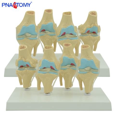 Four Sets Human Knee Model Normal And Abnormal Knee Joints Model