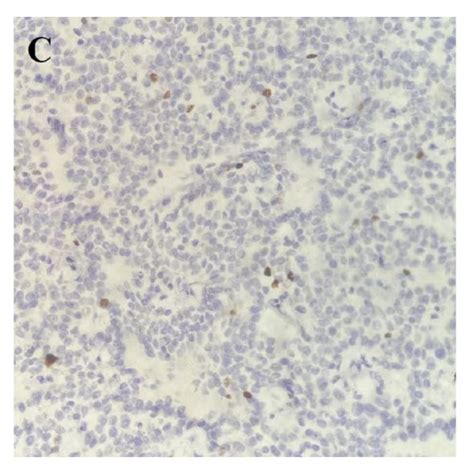 Immunohistochemical Test Results Of Gastric Cancer Patients A Cga