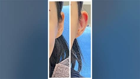 누운귀 접힌귀 교정 원하신다면 필독 귀필러 엘프귀 엘프귀필러 Youtube