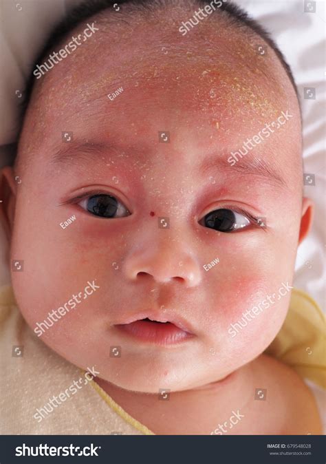 Neonatal Seborrheic Dermatitis