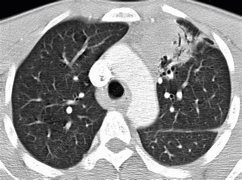 Hodgkins Lymphoma Ct Scan Stock Image C051 8250 Science Photo