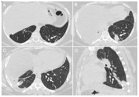 Osteosarcoma Metastasis To The Thorax A Pictorial Review Of Chest