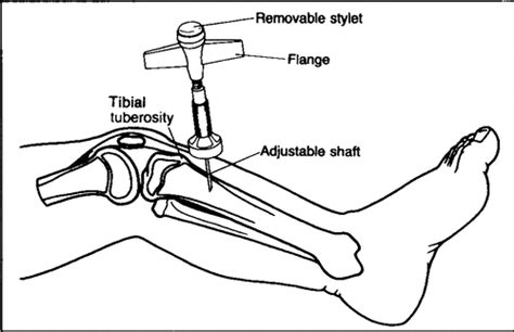 Pediatric Intraosseous Access