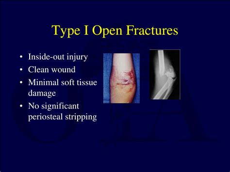 Ppt Fracture Classification Powerpoint Presentation Free Download