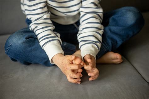 피부 발진이 있는 아이 Roseola 수족구병 엔테로 바이러스 다리 팔 입 아이에게 발진 콕사키 바이러스 아이에 대한 스톡 사진