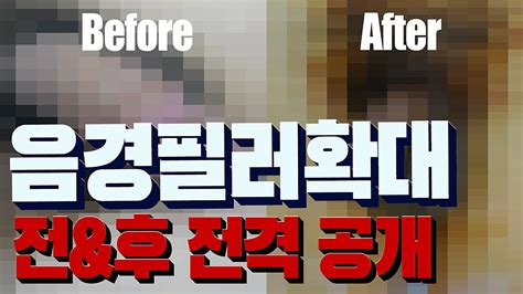 3d 영상으로 보는 필러음경확대의 수술전후 변화 네이버 Tv