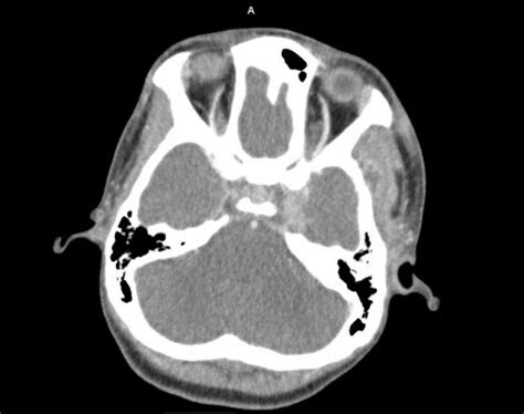 Ludwigs Angina Anterior Neck Abscess And Cavernous Venous Thrombosis