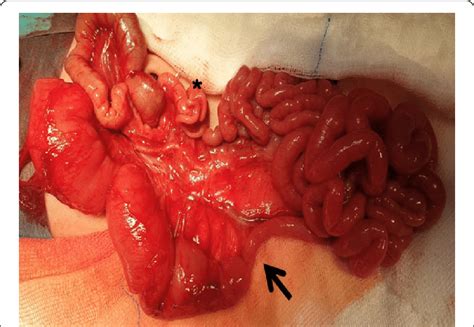 Small Bowel Segment Diameter Difference Arrow Appendix Vermiformis Download Scientific