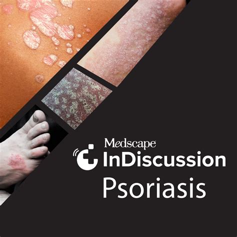 Red Rash And Pustules All Over Heres What To Know Medscape Indiscussion Psoriasis Lyssna