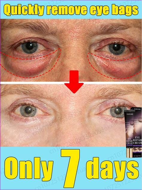 3 Ingredients That Thoroughly Remove Your Eye Bags Eye Bags Remove Eye Bags Eye Bags Treatment