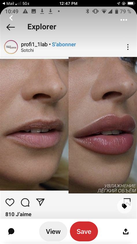 Filler 101 Your Guide To Facial Fillers Artofit