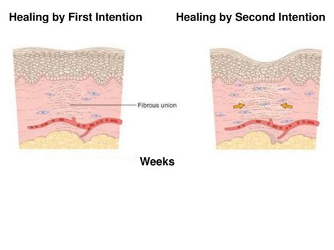 Ppt Inflammation And Repair Powerpoint Presentation Id1993668