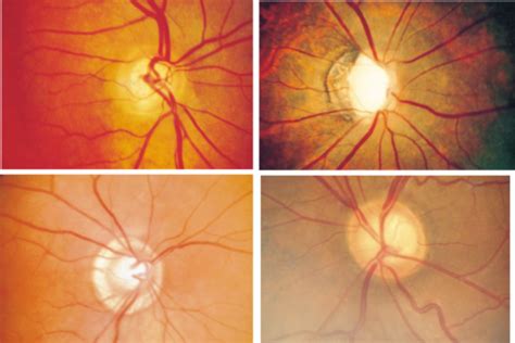 Ocular Disease Week 8 Glaucoma Flashcards Quizlet