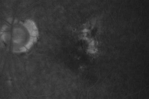 Hyperpigmentation Of Retinal Pigment Epithelium Hyperpigmentation Of The Retinal Pigment