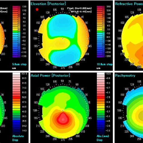 Representative Example Of 6 Color Coded Maps Anterior Elevation Download Scientific Diagram
