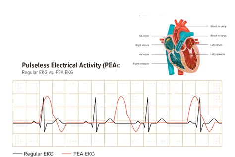 Pulseless Electrical Activity Cardiac Arrest And Resuscitation Willnice