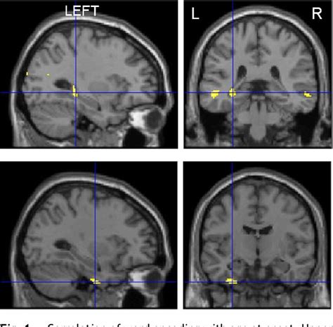 Figure 1 From Factors Affecting Reorganisation Of Memory Encoding Networks In Temporal Lobe