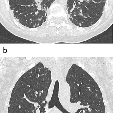 Enlarged Subcarinal Lymph Node White Arrow Without Calcifications