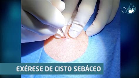 Cisto Seb Ceo Ep Pequeno Cisto Em Dorso Youtube