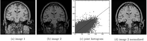Open Access Detection Of Abnormal Diffuse Perfusion In Spect Using A