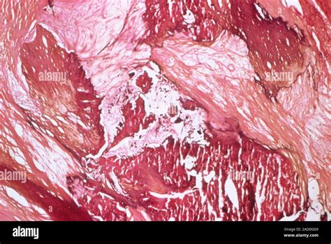 Atherosclerosis Light Micrograph Of A Section Through Part Of A Human Artery With