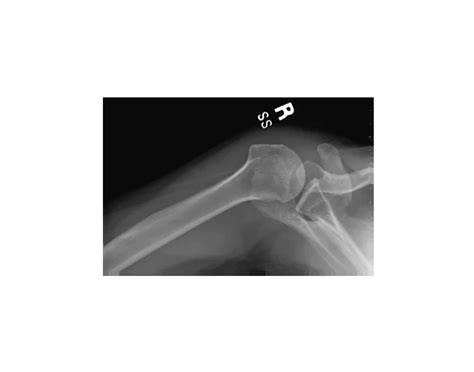 Inferosuperior Axial Projection Lawrence Method Quiz