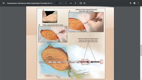Subcutaneous Testosterone Pellet Implantation Procedure For Treatment Of Low Testosterone