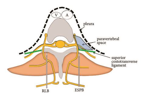 The Injection Point Of The Retrolaminar Block And Erector Spinae Plane Download Scientific