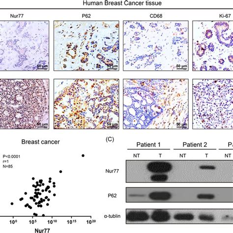 Expression Of Nur77 And P62 In Human Breast Cancer Tissue Samples A