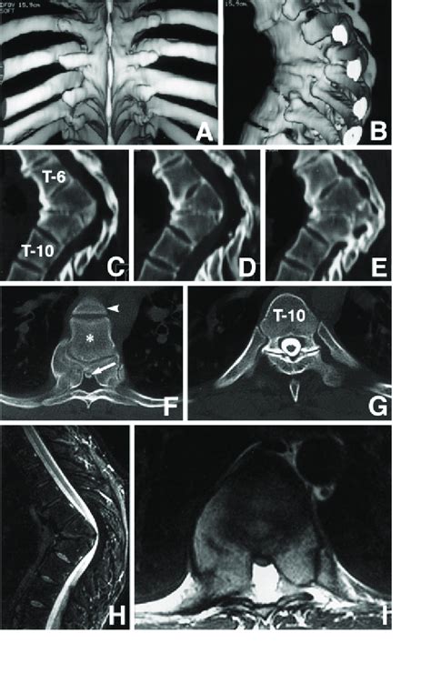 A B Preoperative Posterior A And Lateral B Three Dimensional