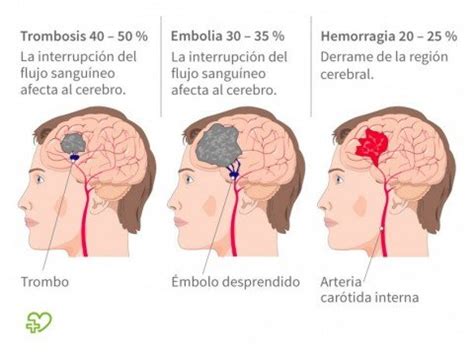 Cuáles son los síntomas mas contundentes ocasionados de un derrame