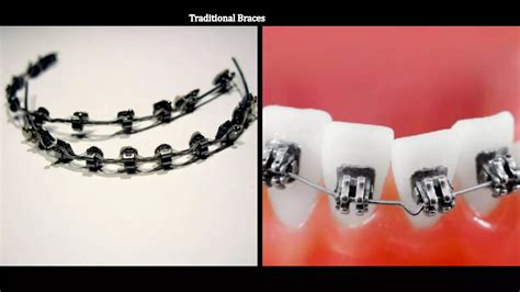 What Is Teeth Spacing Its Causes And Cures Pptx