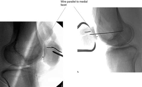 Patella Fractures Musculoskeletal Key