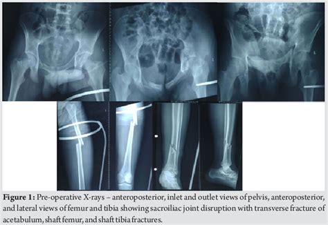 Figure 3 From A Rare Case Of Ipsilateral Floating Ileum” With Floating Hip And Floating Knee