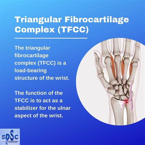 What Is A Tfcc⁠ Sheddon Physiotherapy And Sports Clinic Facebook