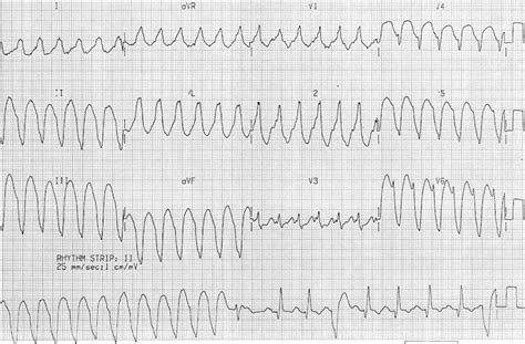 Ventricular Tachycardia Monomorphic Vt Artofit