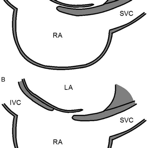 Tee In The 90 Degree Bicaval View Showing A Long Tunnel Pfo In The Download Scientific Diagram