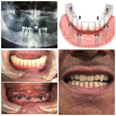Protocolo Sobre Implantes Saiba Como Funciona