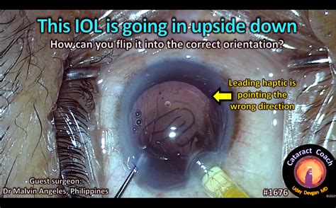 1676 This Iol Is Going In Upside Down Cataract Coach™