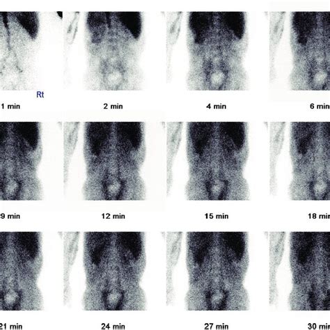 Background Activity Is Greatly Increased On The Renogram Whereas