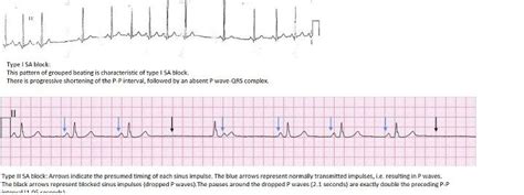 Sinoatrial Block Sinusitis Line Chart Blocks