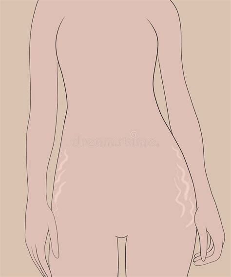 Image Of Stretch Marks On The Upper Thigh Of An Anonymous Naked Woman